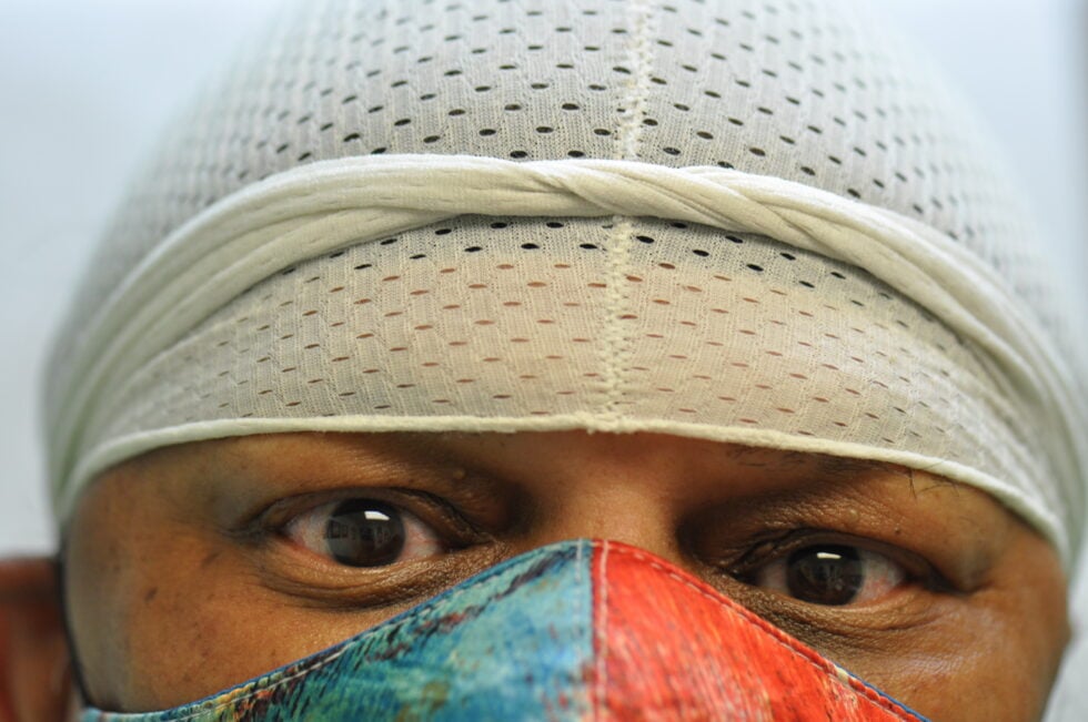 Thyroid eye disease | ARA
