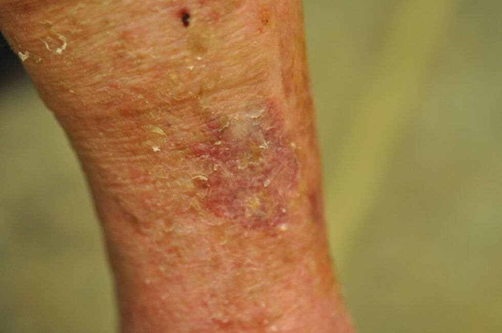 Pyoderma gangrenosum | ARA