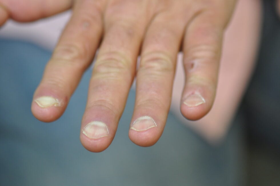 Spoon nails | ARA